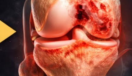 A Powerful Natural Smoothie to Support Cartilage, Ligaments, and Joint ...